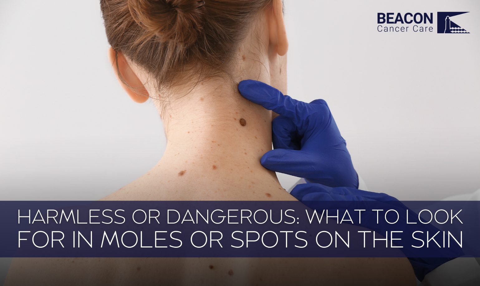 Harmless or Dangerous? What to Look For in Moles or Spots on the Skin ...