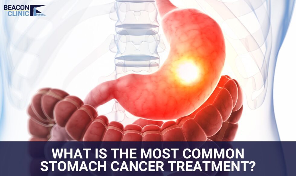 What Is the Most Common Stomach Cancer Treatment? - Beacon Clinic
